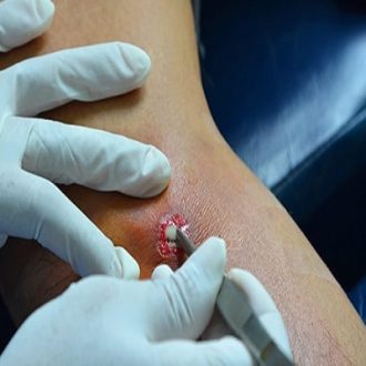 Incision and Drainage of Abscesses in Riyadh & Saudi Arabia | Drainage
